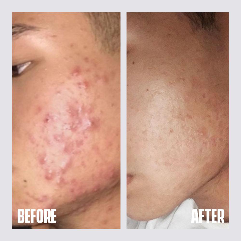 Acne Face Wash - Best Face Wash For Pimples - Dari Mooch